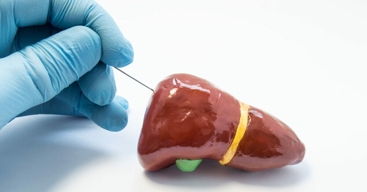 Cirrosi Epatica: Una Patologia Che Conta Circa 20.000 Decessi L’anno ...